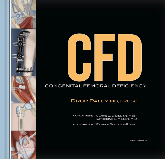 CFD Congenital Femoral Deficiency, First Edition Book – Paley Foundation